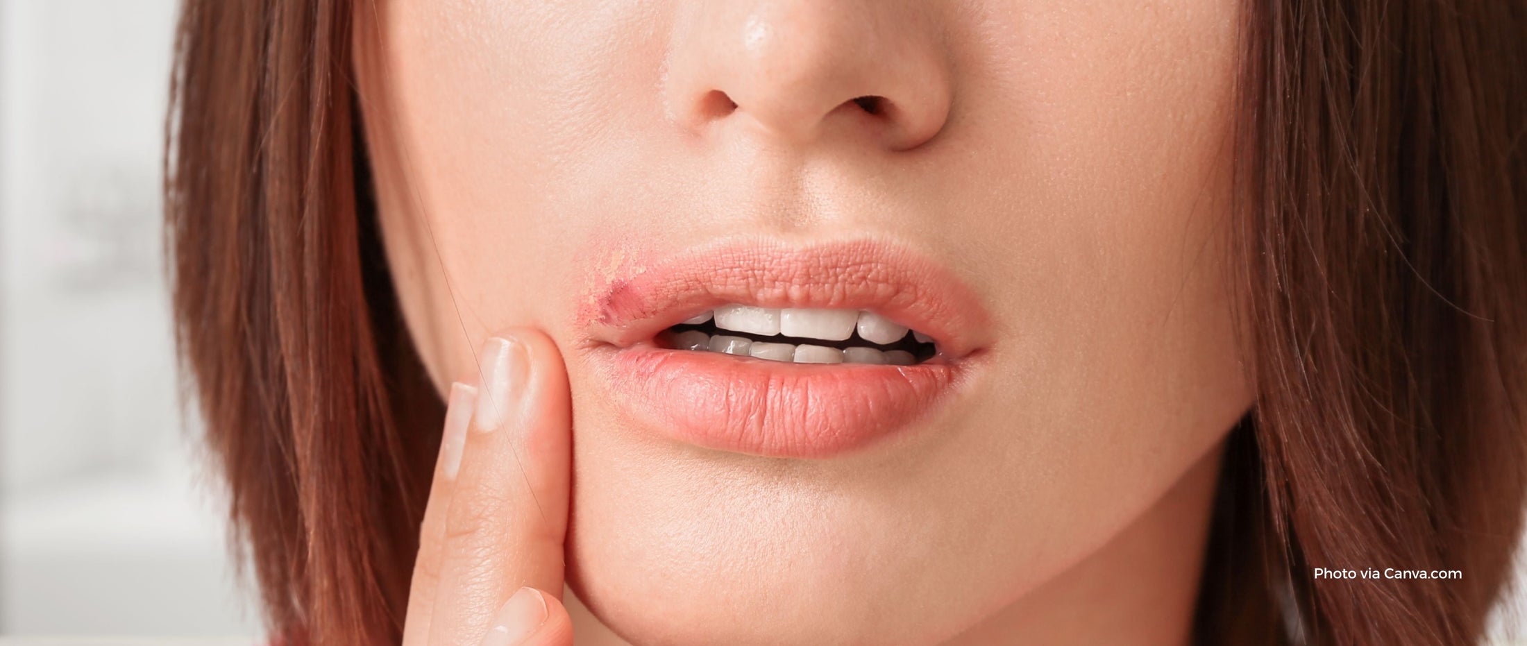 How to Get Rid of Cold Sores Fast: The Complete Guide to Cold Sore Pat ...