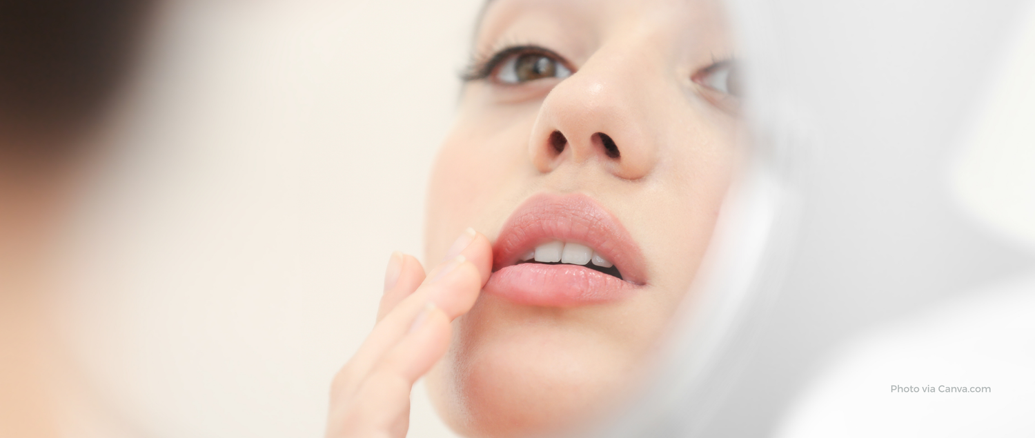 Cold Sores: What They Are, Why They Happen, and How to Deal With Them ...
